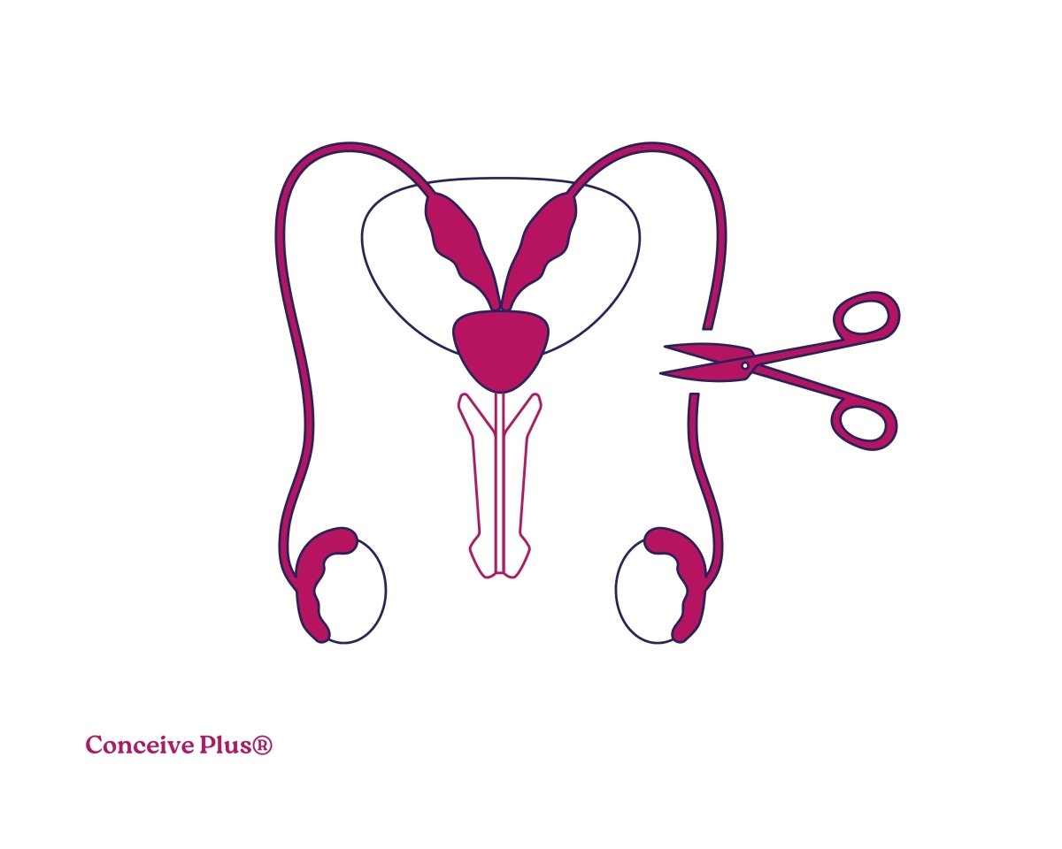 A Simple Guide to Vasectomy Medical Term | Conceive Plus®