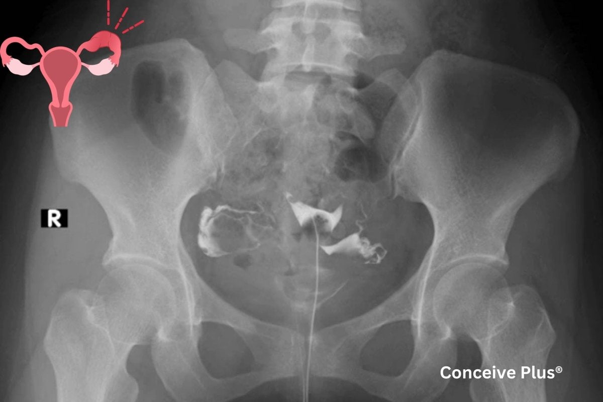 Hysterosalpingogram HSG Cost | Conceive Plus® – Conceive Plus® Online Store